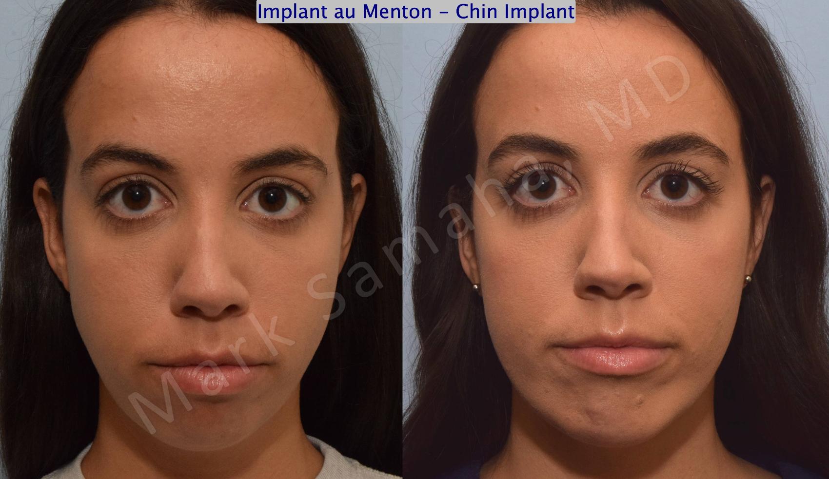 Augmentation du menton / Chin Augmentation Avant & Après Photos ...