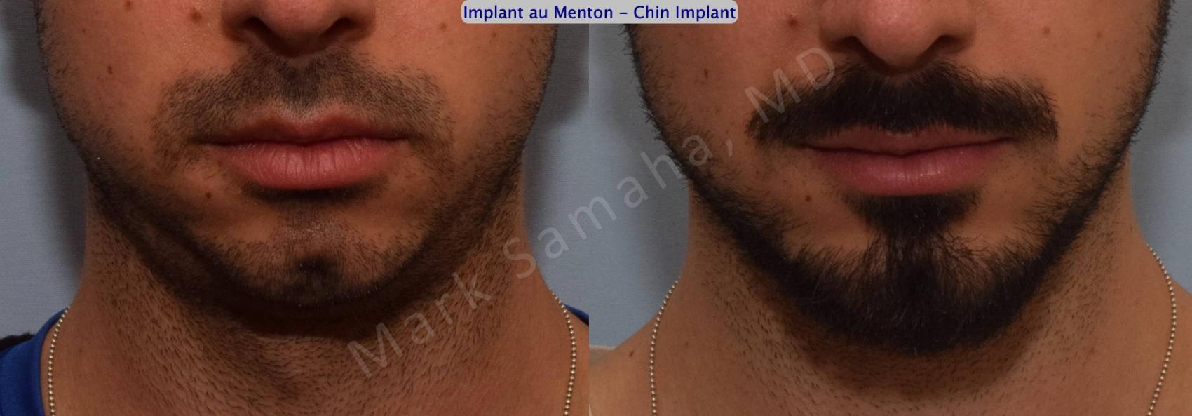 Augmentation du menton / Chin Augmentation Avant & Après Photos ...