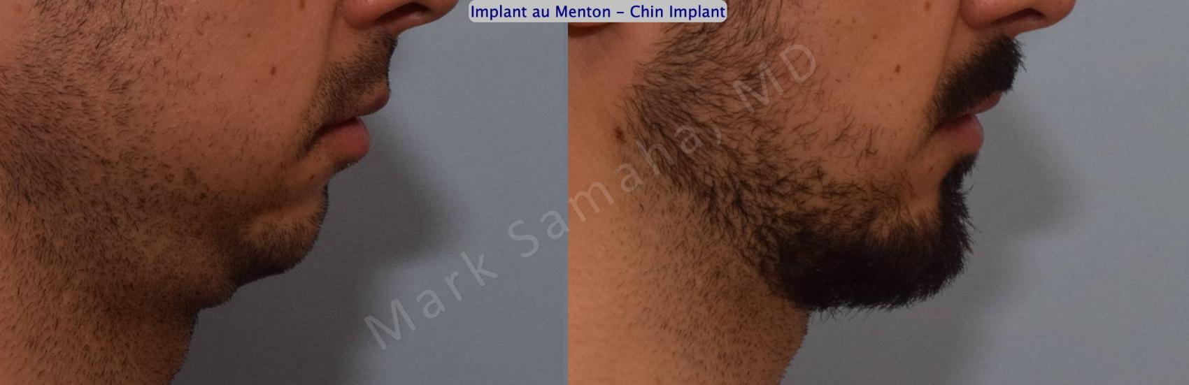 Augmentation du menton / Chin Augmentation Avant & Après Photos ...