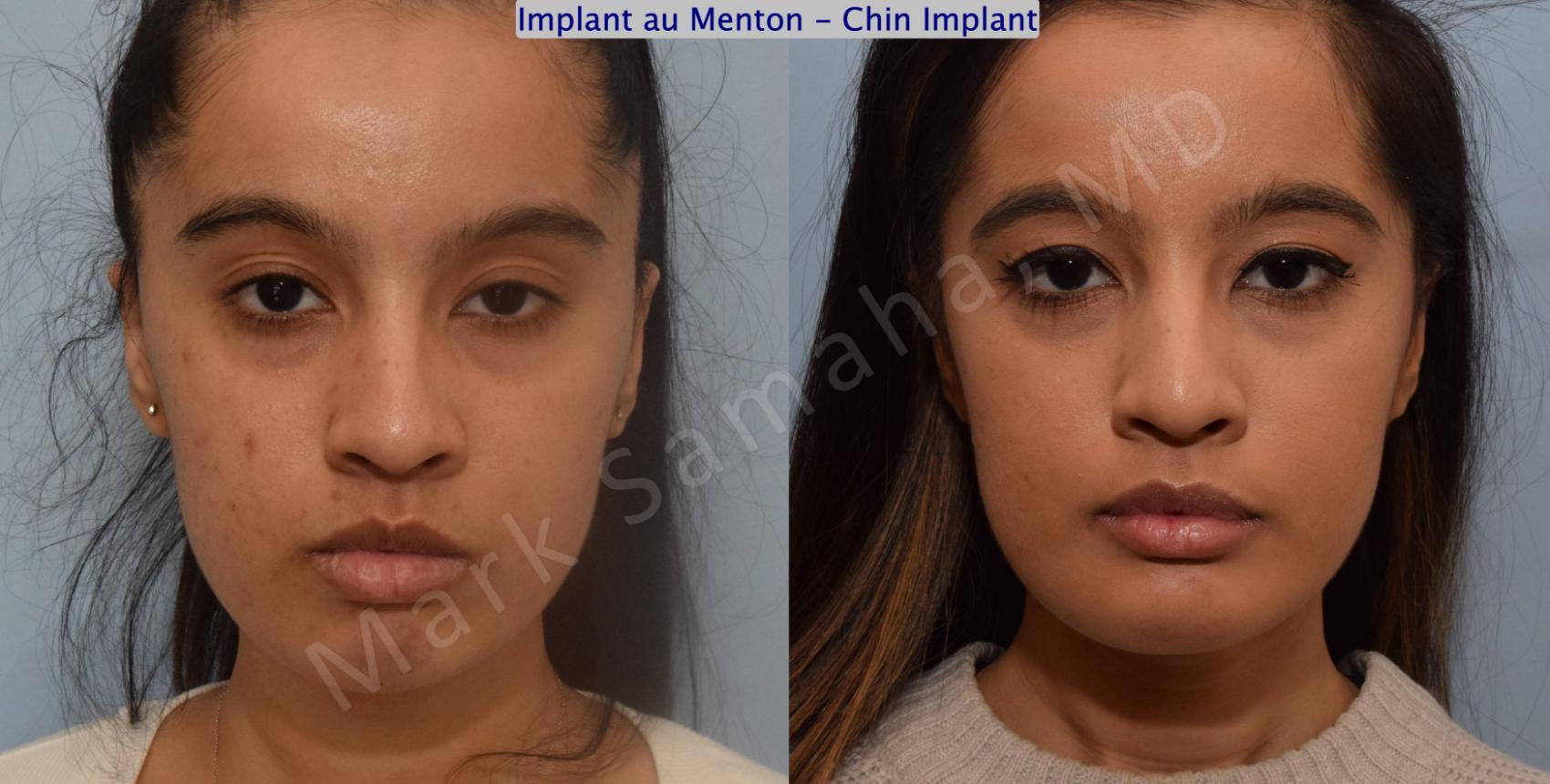 Augmentation du menton / Chin Augmentation Avant & Après Photos ...
