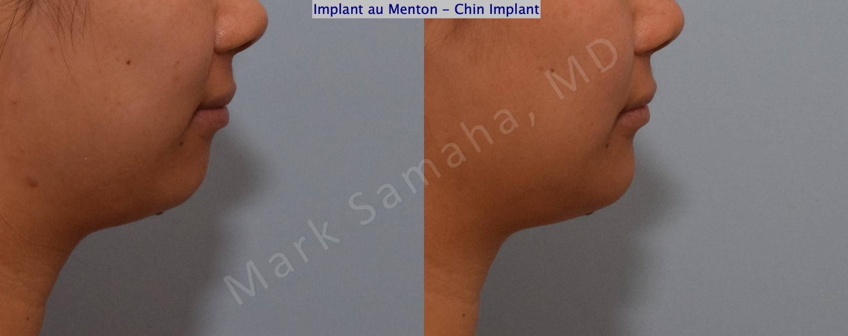 Augmentation du menton / Chin Augmentation Avant & Après Photos ...