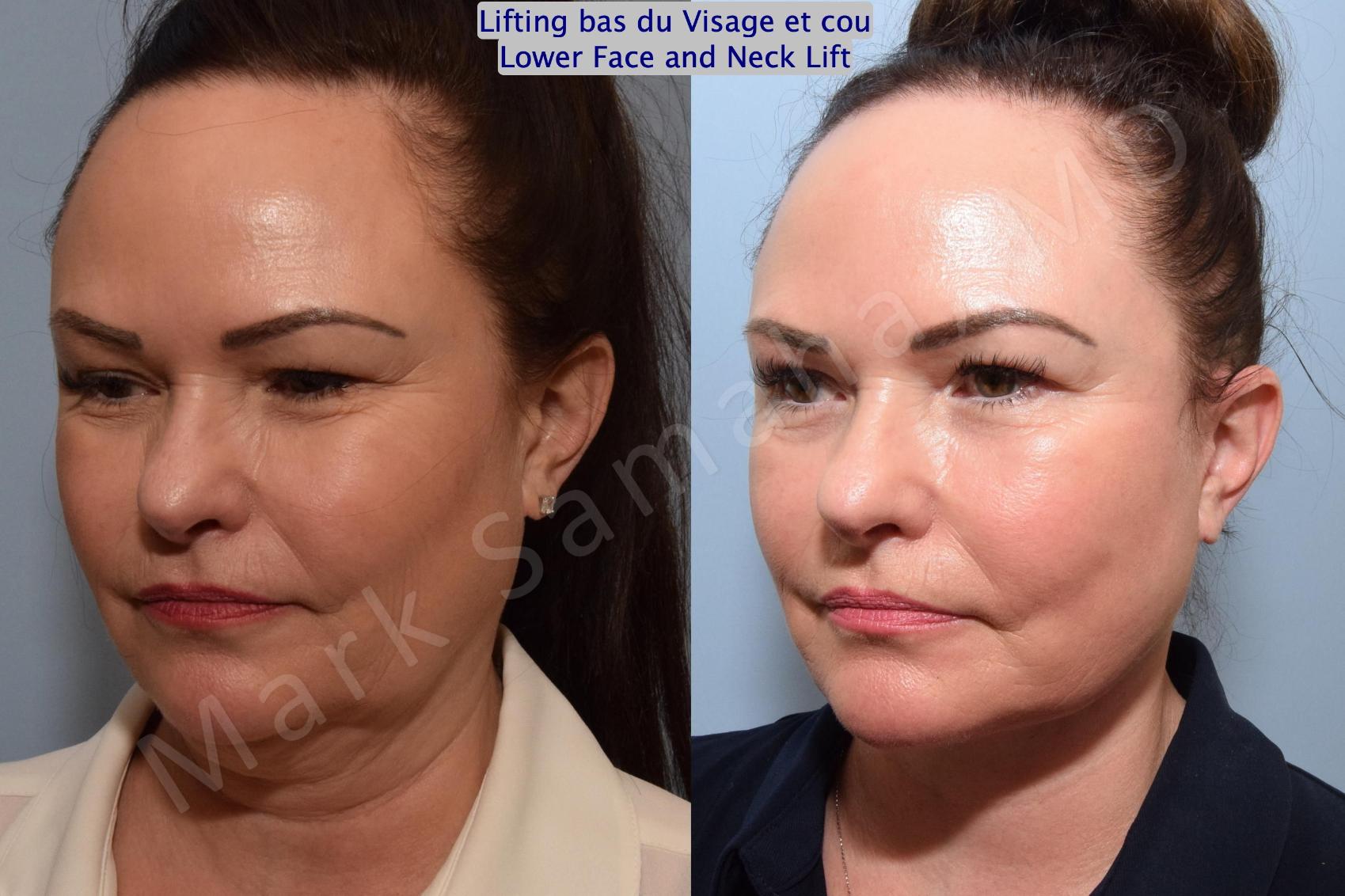 Lifting du visage / Cou - Facelift / Necklift Avant & Après Photos ...
