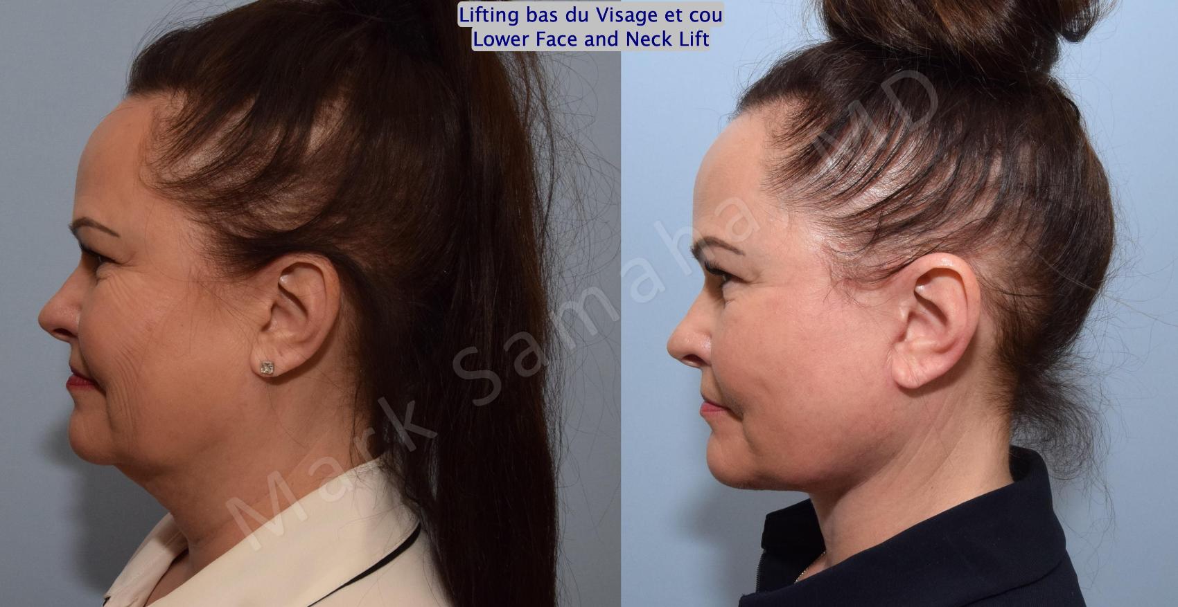 Lifting du visage / Cou - Facelift / Necklift Avant & Après Photos ...