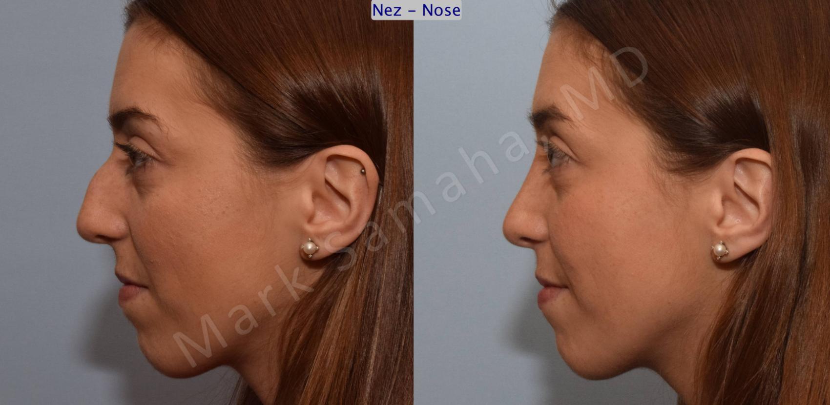 Rhinoplastie / Rhinoplasty Avant & Après Photos / Before and After ...