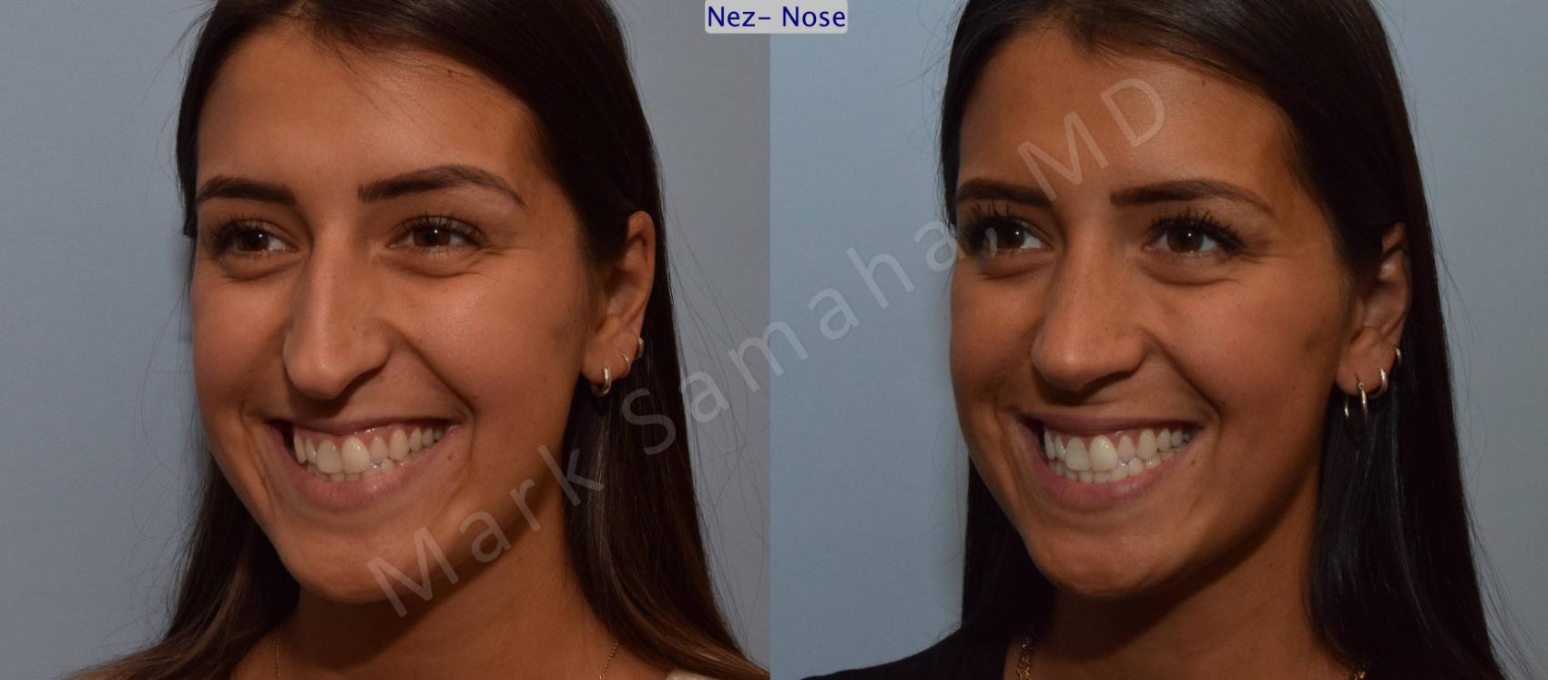 Rhinoplastie / Rhinoplasty Avant & Après Photos / Before and After ...