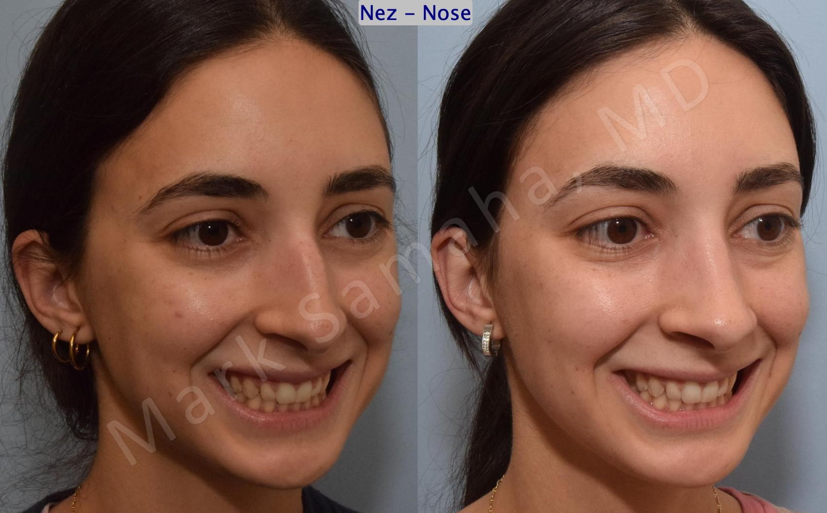 Rhinoplastie / Rhinoplasty Avant & Après Photos / Before and After ...