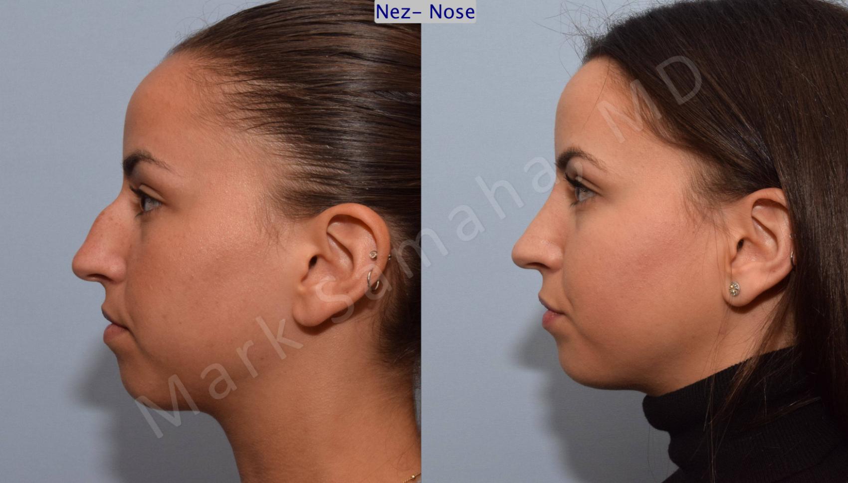 Rhinoplastie / Rhinoplasty Avant & Après Photos / Before and After ...
