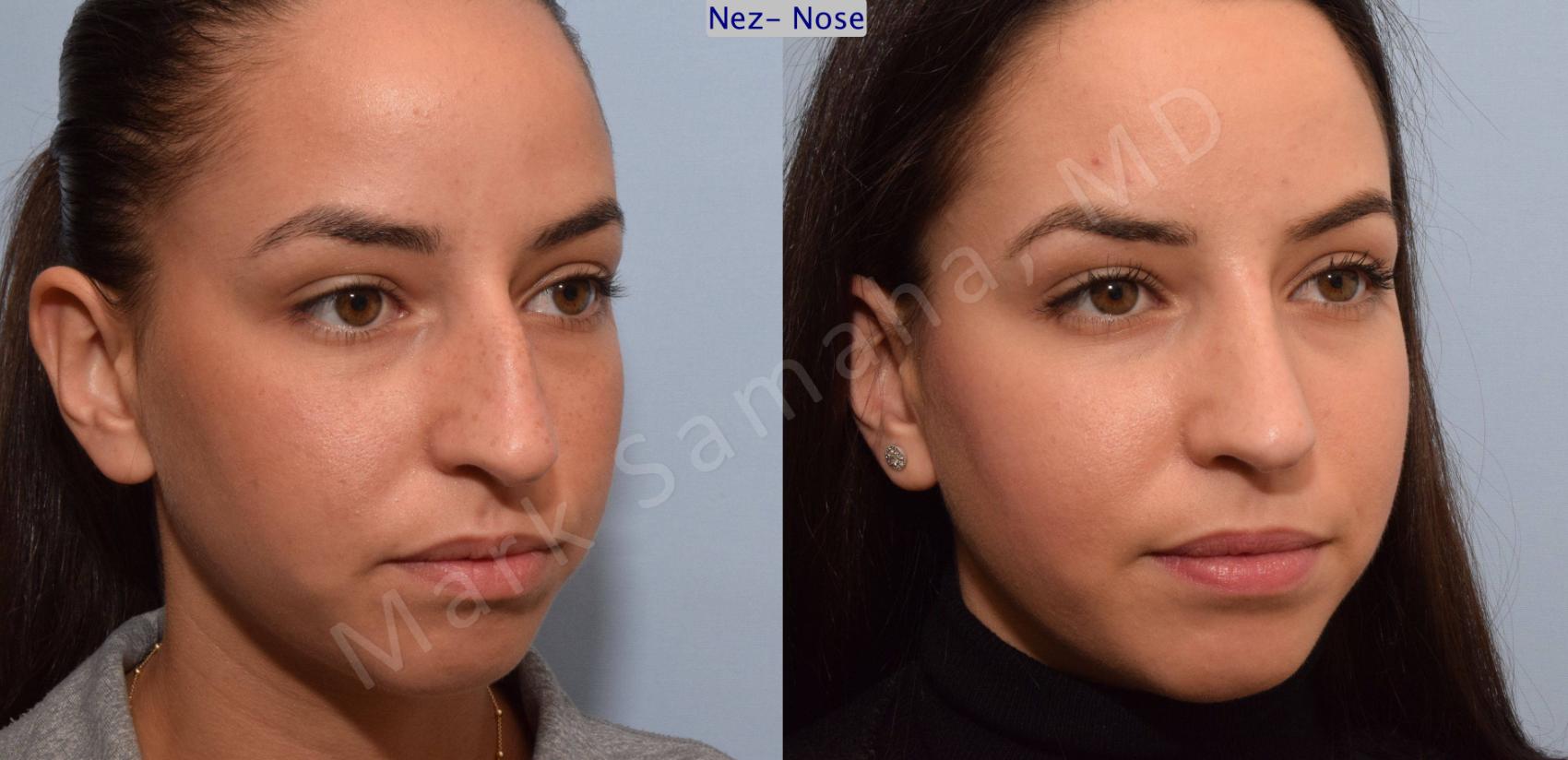 Rhinoplastie / Rhinoplasty Avant & Après Photos / Before and After ...