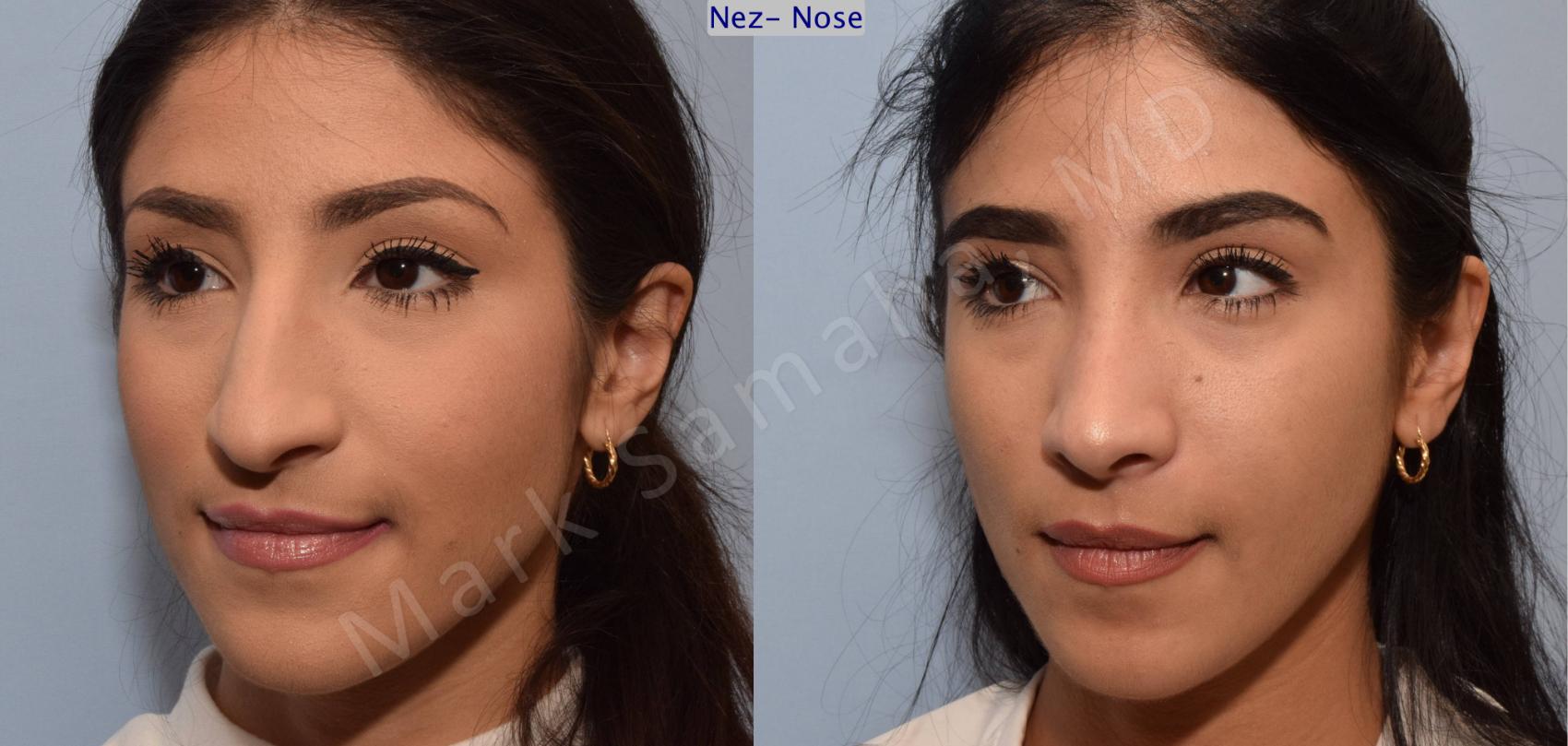 Rhinoplastie / Rhinoplasty Avant & Après Photos / Before and After ...